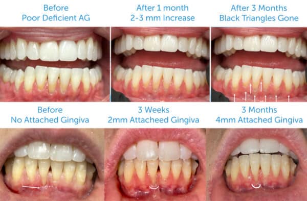 Gum Builder & Filler Training - Black Triangle | AAFE